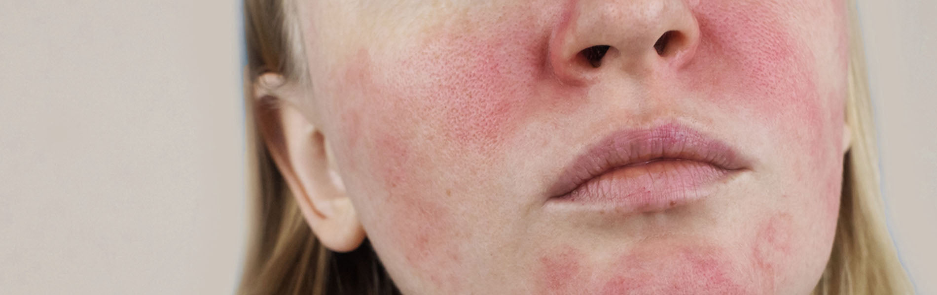 Understanding Rosacea: How LED Light Therapy Can Help | Project E Beauty
